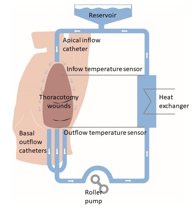 Hyperthermic Intrathoracic Chemotherapy is Associated with Longer ...